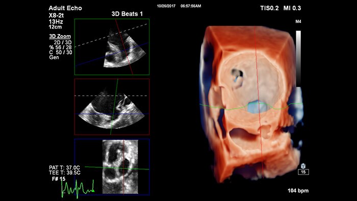 Structural Heart Disease (SHD) | Philips