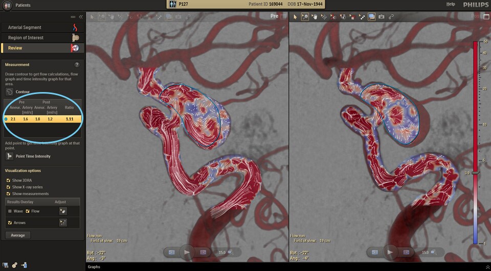 Neuro suite - Image guided therapy | Philips Healthcare
